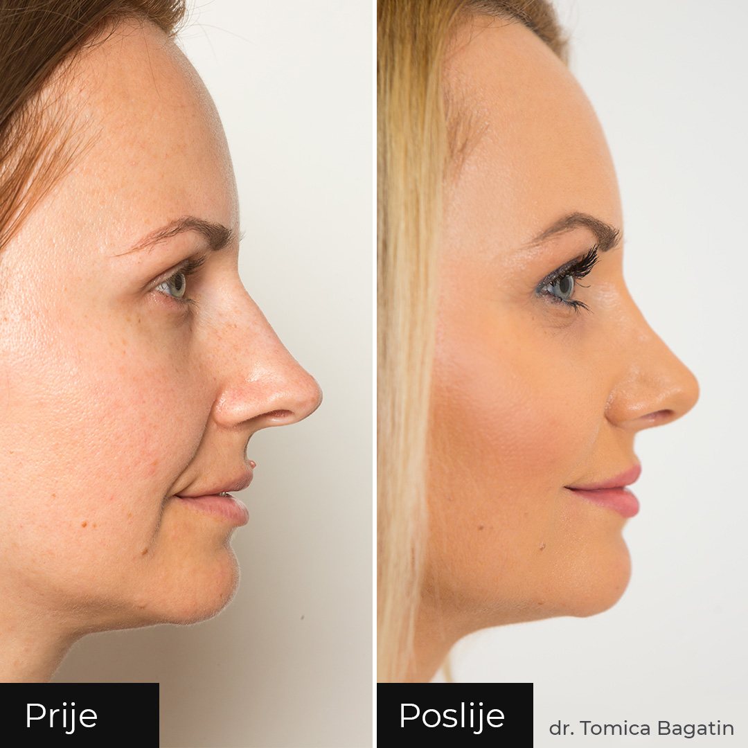 Operacija nosa je puno više od same estetike. Stručnjak objašnjava nove ...