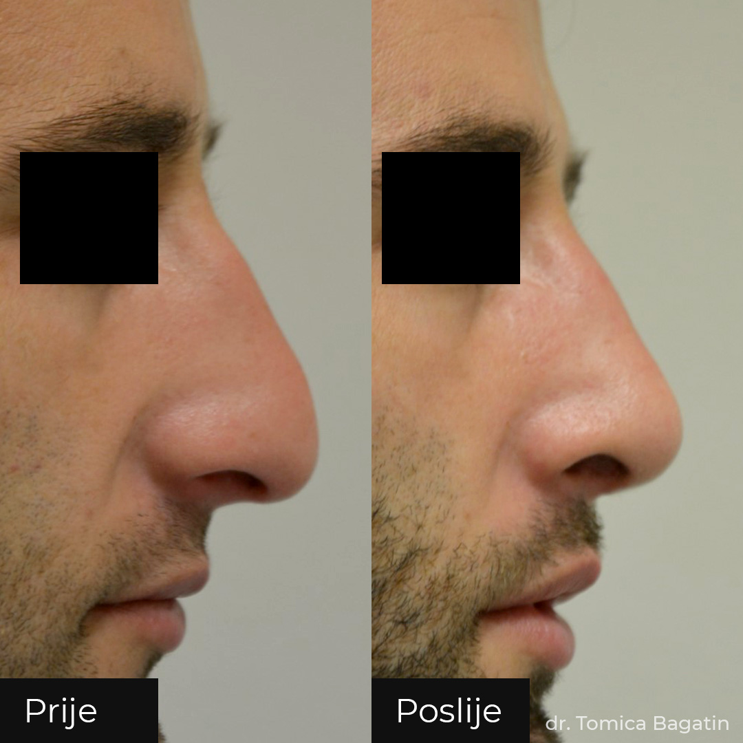 Operacija nosa je puno više od same estetike. Stručnjak objašnjava nove ...