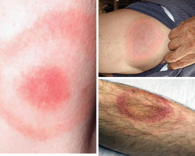 Nemojte ignorirati crvenilo na koži u obliku kruga | Telegram.hr