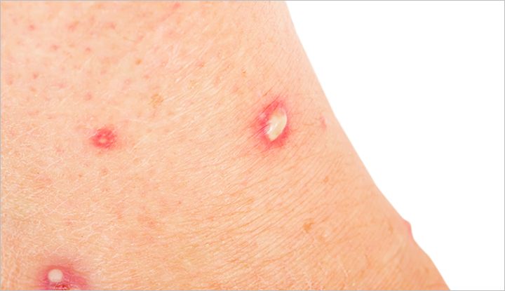 Vatreni mravi stigli u Europu: Kako prepoznati ugriz mrava? | Telegram.hr