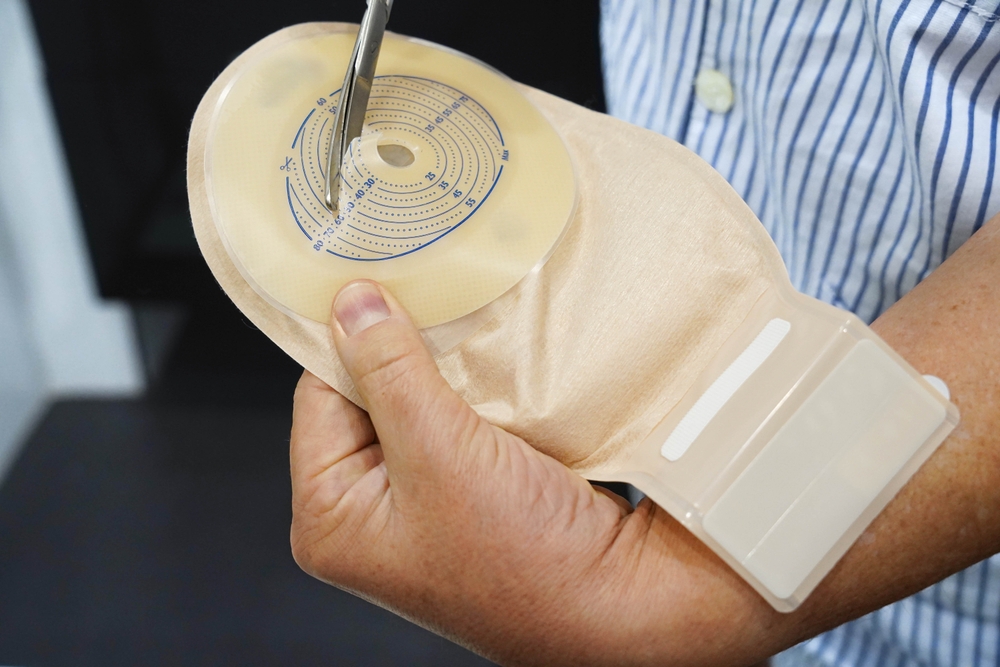 Što je stoma, zašto se postavljaju i kako se pravilno njeguju ...