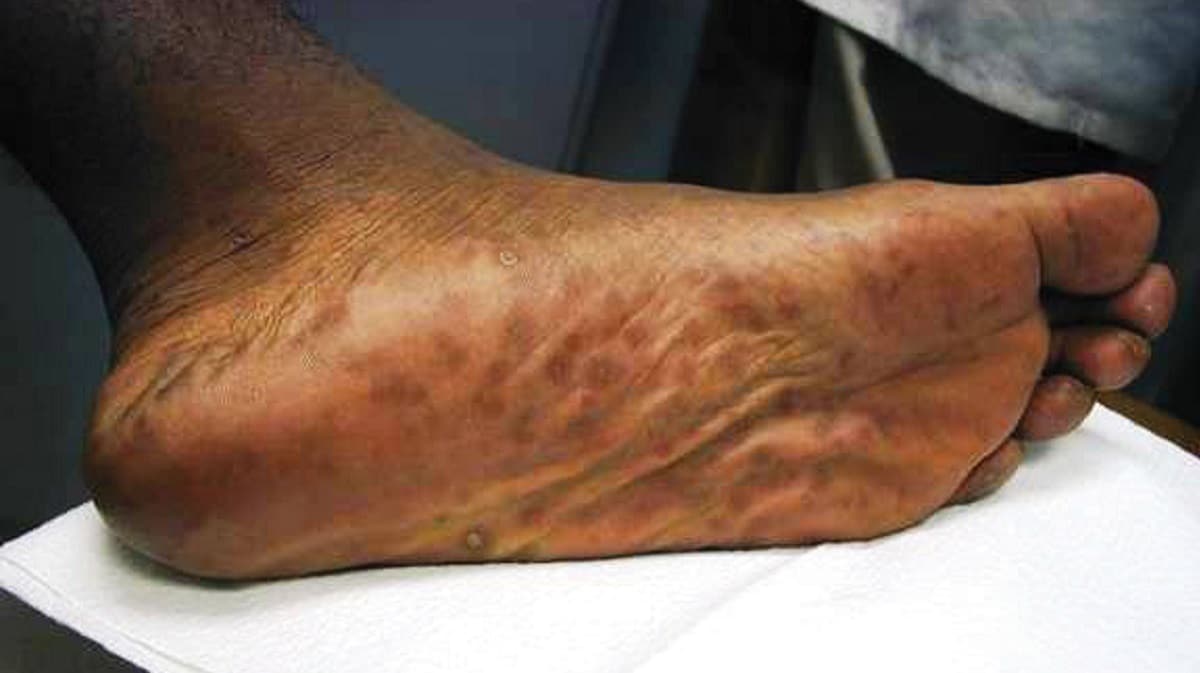 Sifilis: Simptomi infekcije, kako se prenosi i liječenje | Telegram.hr