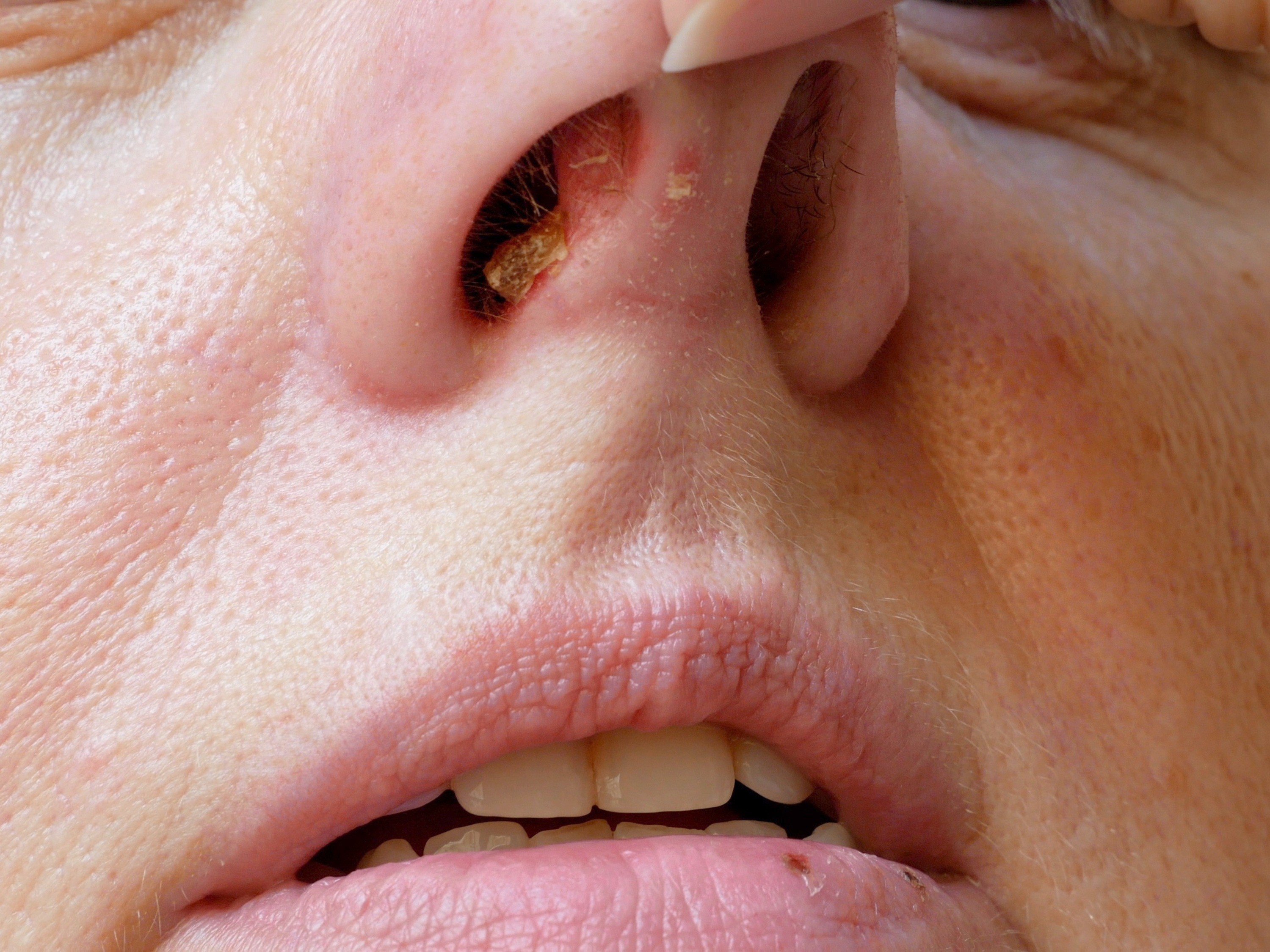 Herpes u nosu: Što ga uzrokuje i kako ga brzo zaliječiti? | Telegram.hr