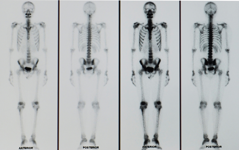 Multipli mijelom: Simptomi i kolike su šanse za preživljavanje ...