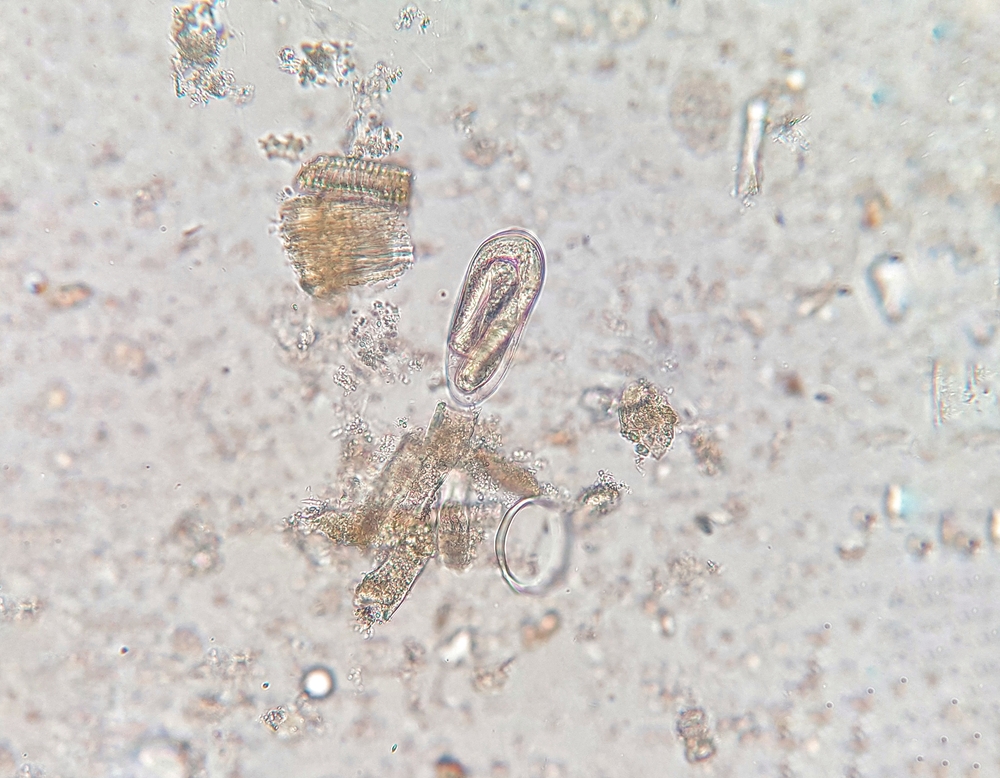 Kako izgledaju gliste u stolici kod odraslih i djece? Trajanje i ...