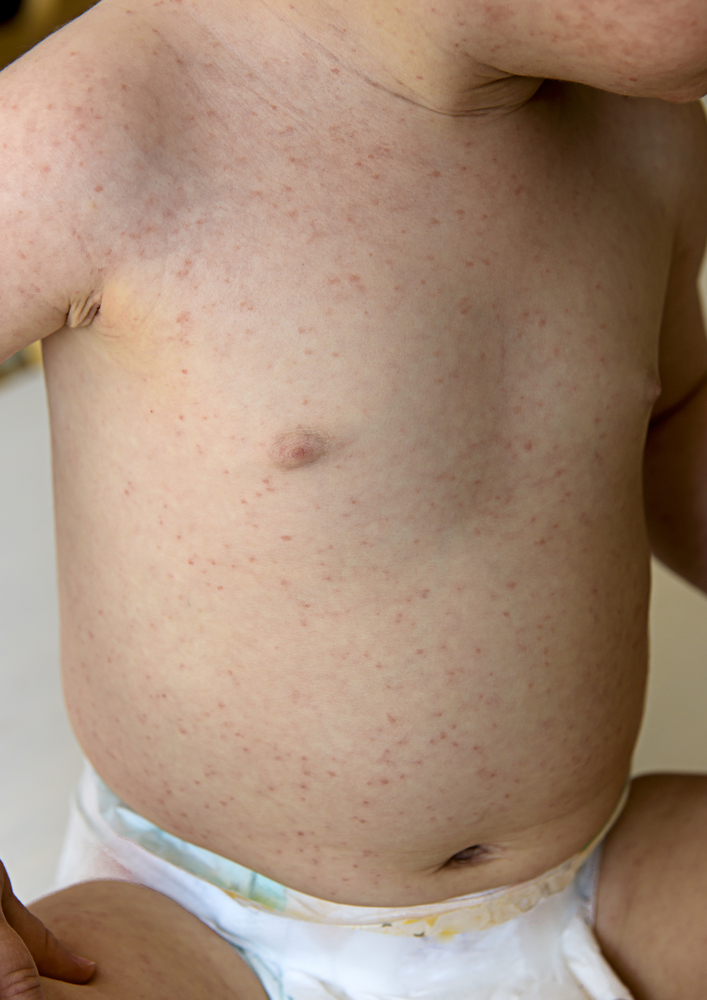 Kako se liječi trodnevna groznica kod djece i odraslih? | Telegram.hr