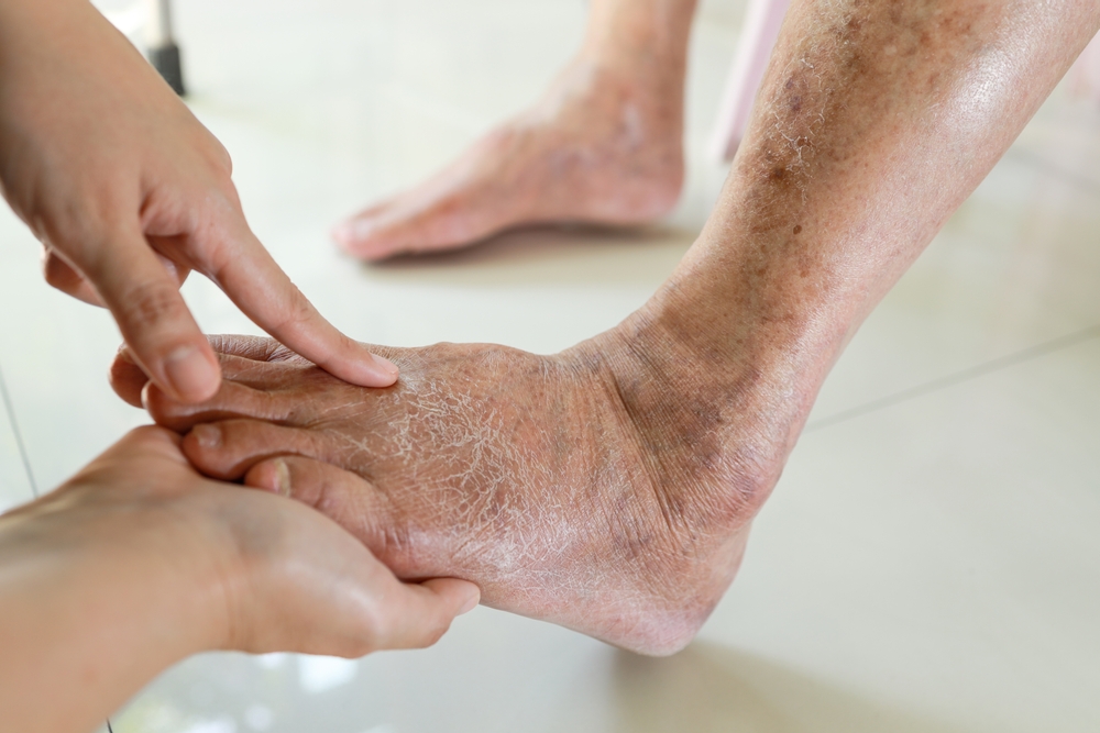 Dijabetičko stopalo: Prevencija ozbiljnih komplikacija i amputacije ...