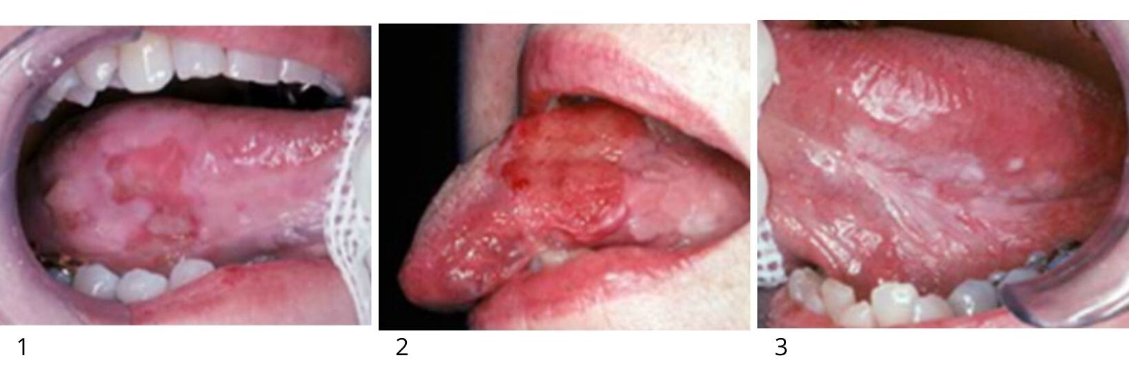Kako izgleda rak jezika? Simptomi, fotografije i liječenja | Telegram.hr