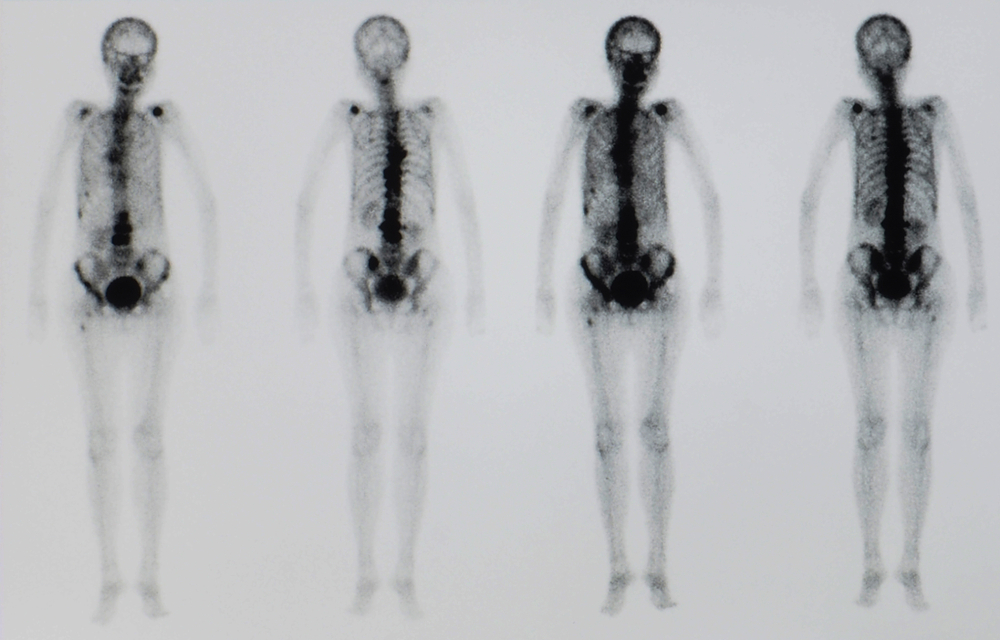 Rak kostiju: Simptomi, vrste i scintigrafija za dijagnosticiranje | Telegram.hr