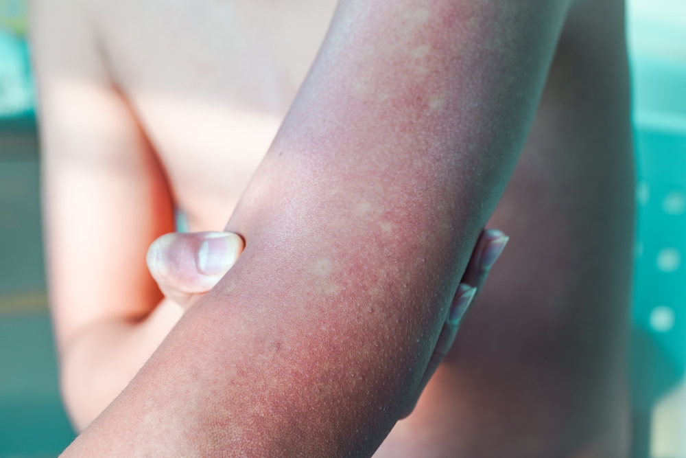 Denga groznica: simptomi, prijenos i slučajevi u Hrvatskoj | Telegram.hr