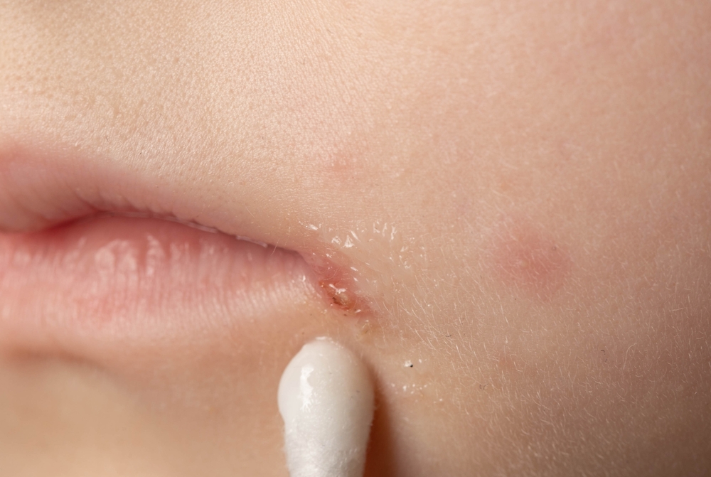 Žvale na ustima: Zašto nastaju i kako ih liječiti? | Telegram.hr