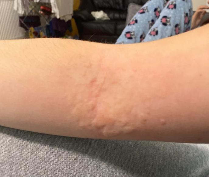 Alergija na mačke: Simptomi (slike), uzroci i liječenje | Telegram.hr